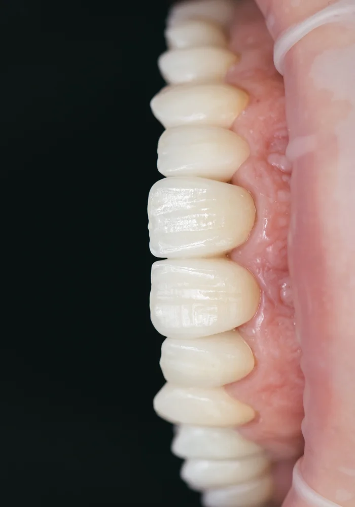 Porcelain Crowns (Caps) - Smile Dental Arts Centre
