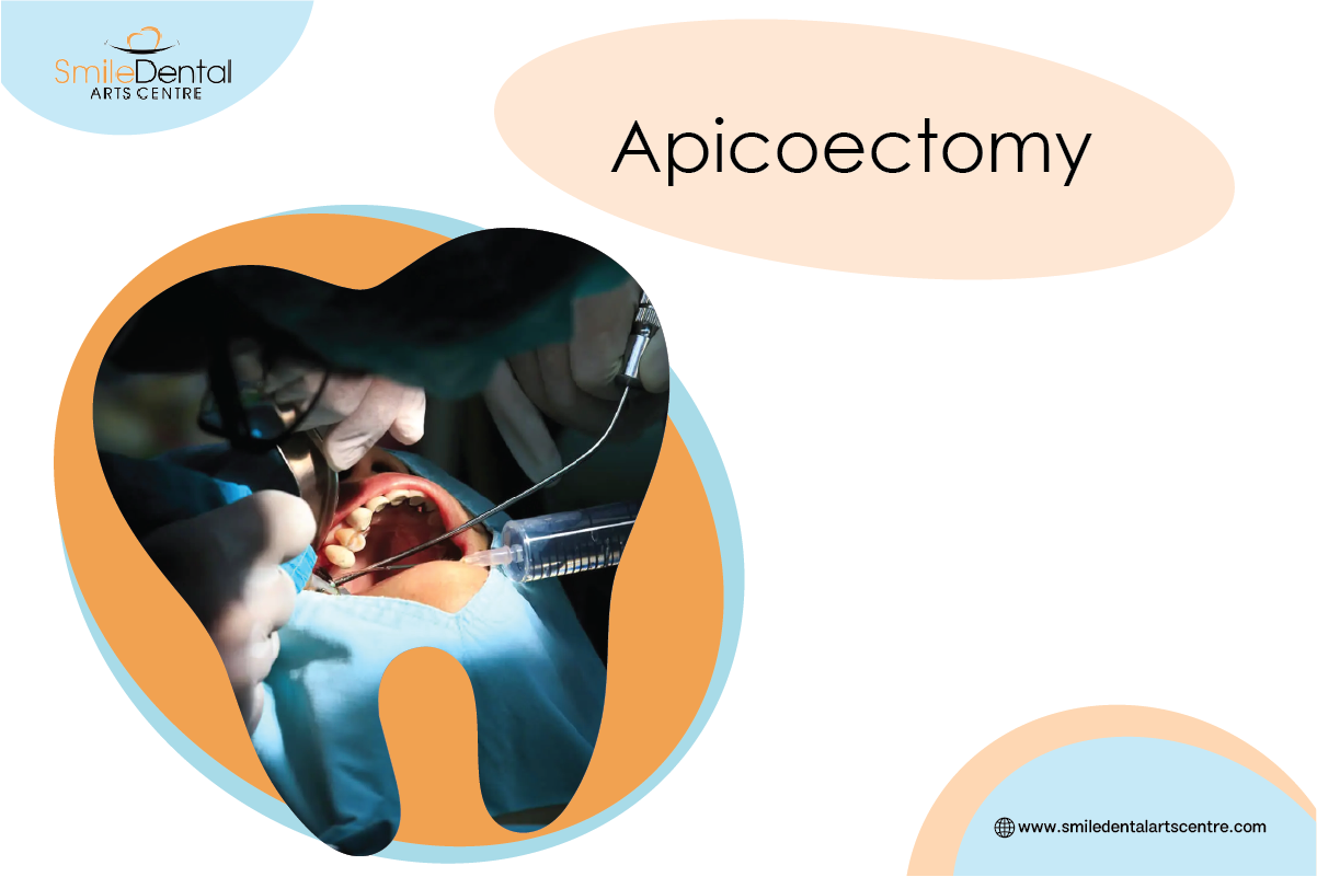 What is an Apicoectomy and When is it Needed?